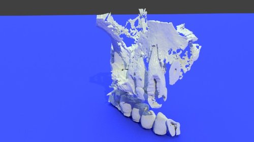 CBCT Scan - stl file processed - Dental, Orthodontic, Maxillofacial ...