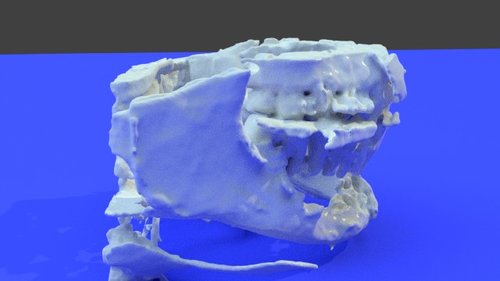 ram singh mandible cancer - stl file processed - Dental, Orthodontic ...