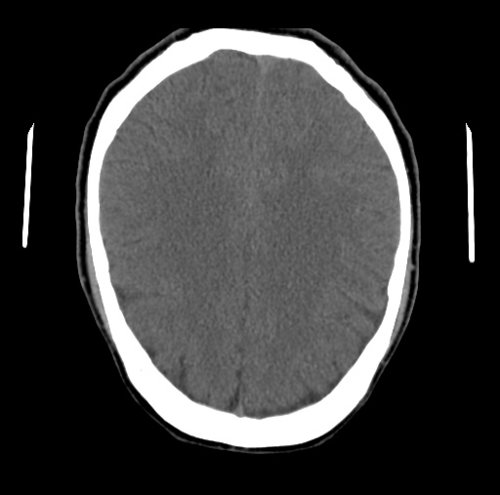 Brain - Skull, Head, and Neck CTs - embodi3D.com