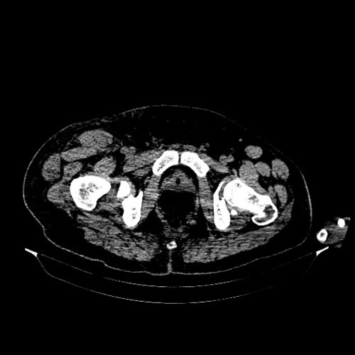 KidneyFullBody - Whole Body CTs - embodi3D.com