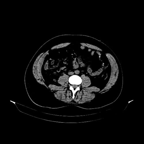 KidneyFullBody - Whole Body CTs - embodi3D.com