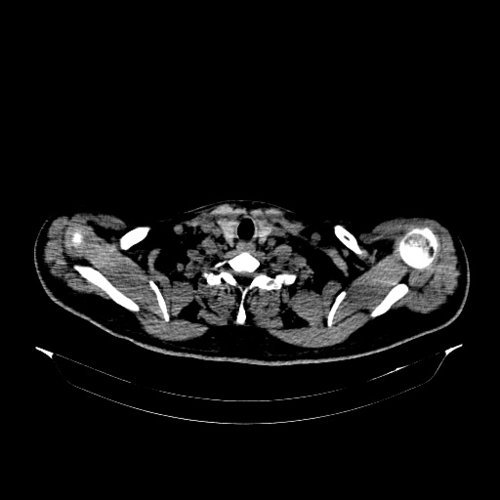 KidneyFullBody - Whole Body CTs - embodi3D.com