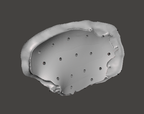 Patient Specific Implant - Cranial Plate Ready for Print in Metal ...