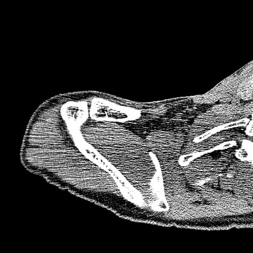 arm - Upper Extremity CTs - embodi3D.com