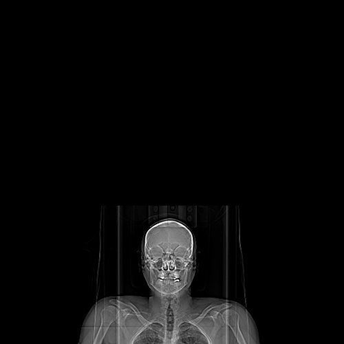 eagle syndrome - Skull, Head, and Neck CTs - embodi3D.com