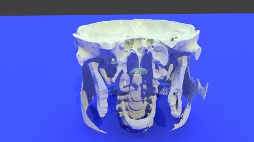second CT scan facial and cervical - stl file processed - Spine and ...