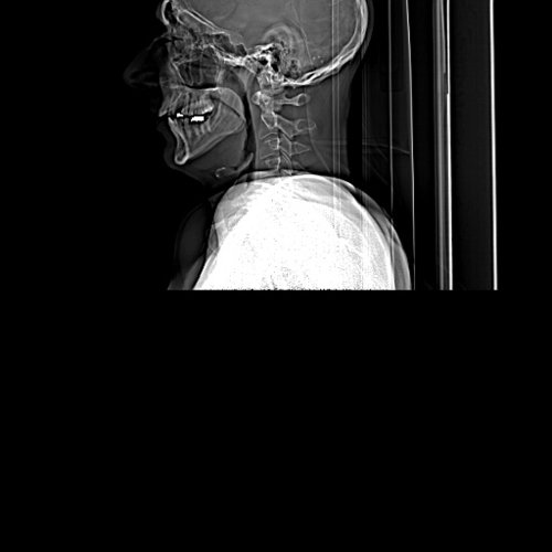 eagle syndrome - Skull, Head, and Neck CTs - embodi3D.com