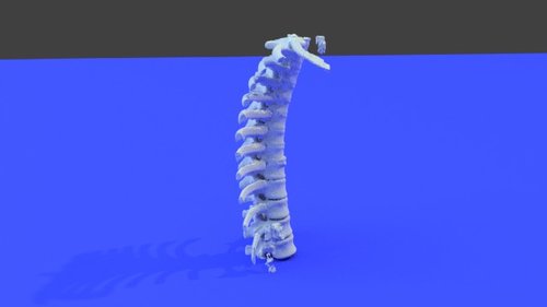 spine lesion - stl file processed - Spine and Pelvis - embodi3D.com
