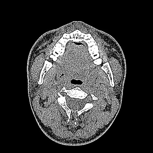Head CT Scan - Skull, Head, and Neck CTs - embodi3D.com