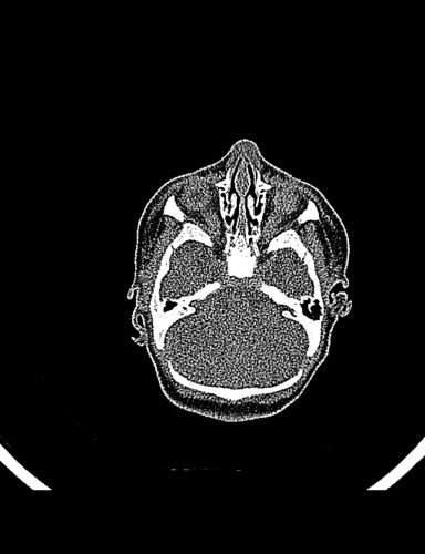 infant male axial thin bone CT scan skull/head - Skull, Head, and Neck ...