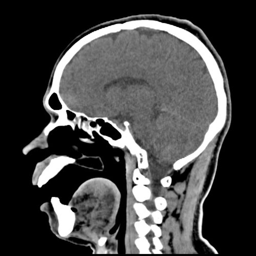 head muscles test 1 - Skull, Head, and Neck CTs - embodi3D.com