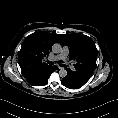 tap IV - fracture bassin - Abdomen and Pelvis CTs - embodi3D.com