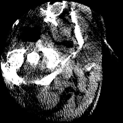 ear - Skull, Head, and Neck CTs - embodi3D.com