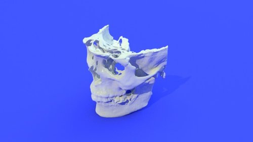 scan jawbone and teeth - stl file processed - Dental, Orthodontic ...