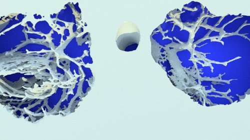 COPD Lungs - Lungs - embodi3D.com