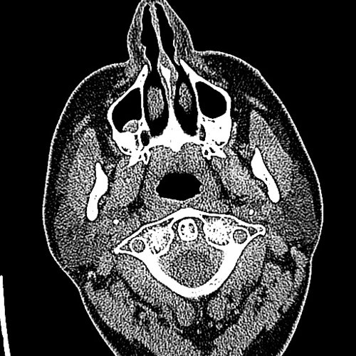 suni - Skull, Head, and Neck CTs - embodi3D.com
