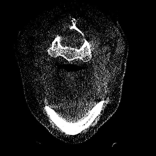 converting to stl - Dental, Orthodontic, Maxillofacial CTs - embodi3D.com