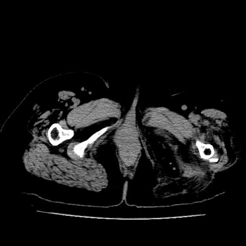 Mummy_Thigh_Muscles - Abdomen and Pelvis CTs - embodi3D.com