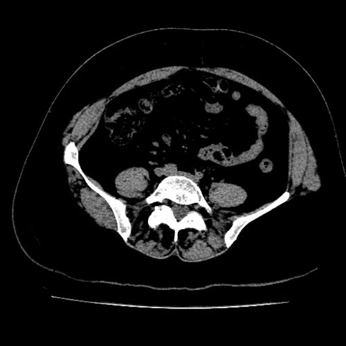 Mummy_Thigh_Muscles - Abdomen and Pelvis CTs - embodi3D.com