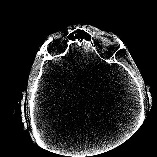 CT Scan 2019 - Skull, Head, and Neck CTs - embodi3D.com