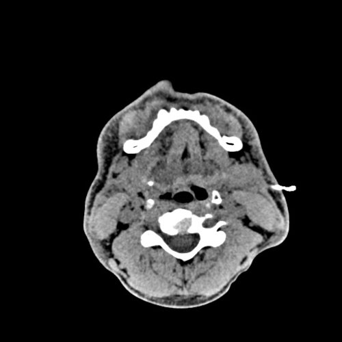 3D Head CT scan - Skull, Head, and Neck CTs - embodi3D.com
