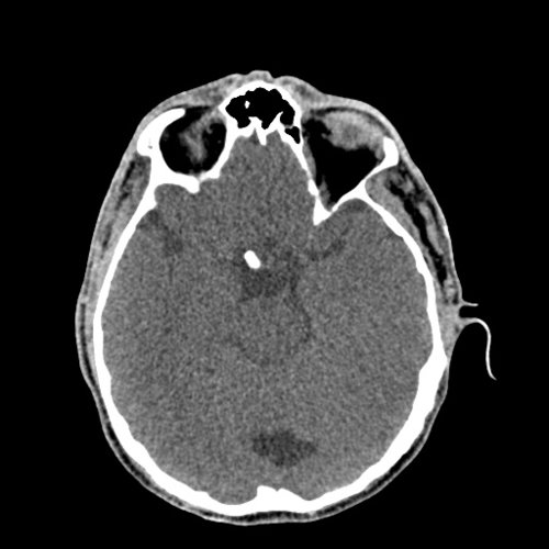 3D Head CT scan - Skull, Head, and Neck CTs - embodi3D.com