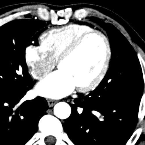 heart dicom - Thorax CTs - embodi3D.com