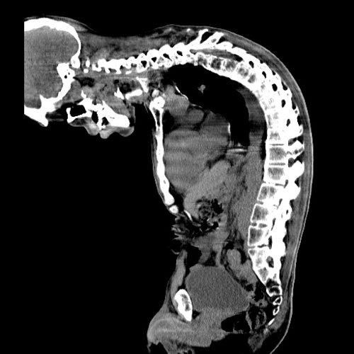 processed 1 - Whole Body CTs - embodi3D.com