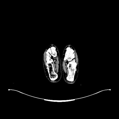 rt leg trauma lt leg comparison - Lower Extremity CTs - embodi3D.com