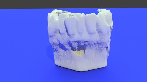 Dental CBCT - stl file processed - Dental, Orthodontic, Maxillofacial ...