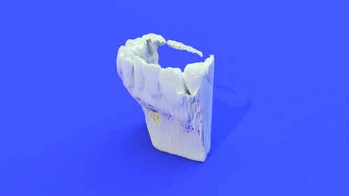 Dental CBCT - stl file processed - Dental, Orthodontic, Maxillofacial ...