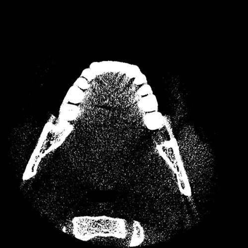 Teeth Muscle - Dental, Orthodontic, Maxillofacial CTs - embodi3D.com