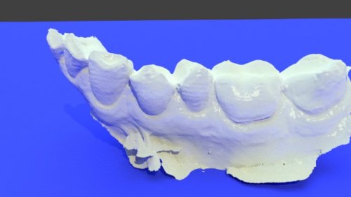 Patient cavity scan - Dental, Orthodontic, Maxillofacial - embodi3D.com