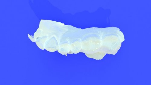 Patient cavity scan - Dental, Orthodontic, Maxillofacial - embodi3D.com