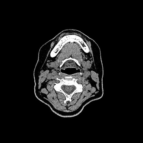 tmj disorder - Skull, Head, and Neck CTs - embodi3D.com