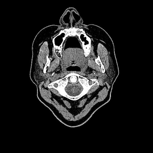tmj disorder - Skull, Head, and Neck CTs - embodi3D.com