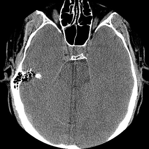 Scull to thoracic spine - Spine CTs - embodi3D.com