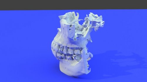 teeth - stl file processed - Dental, Orthodontic, Maxillofacial ...