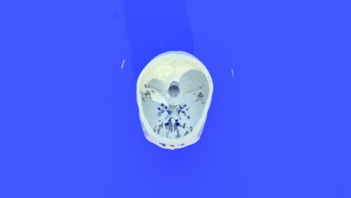DICOM - stl file processed - Dental, Orthodontic, Maxillofacial CTs ...