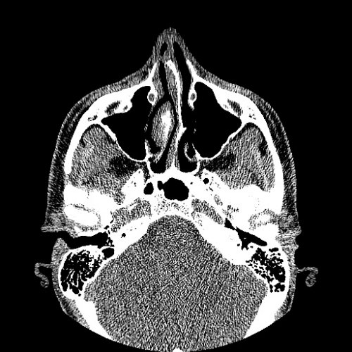 Facial scan with mandibular fracture - Skull, Head, and Neck CTs ...