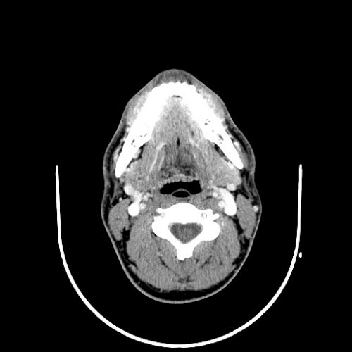 BONE CT scan neck - Skull, Head, and Neck CTs - embodi3D.com