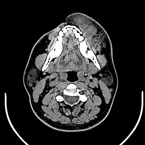 Dicom - Skull, Head, and Neck CTs - embodi3D.com