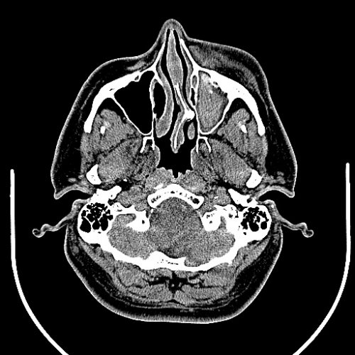 Dicom - Skull, Head, and Neck CTs - embodi3D.com