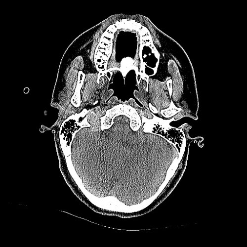 head ct - Skull, Head, and Neck CTs - embodi3D.com