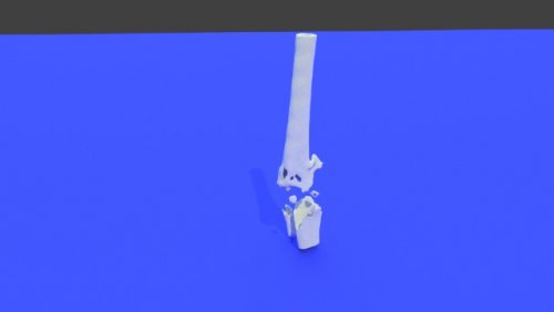 Femur Fracture - stl file processed - Extremity, Lower (Leg) - embodi3D.com