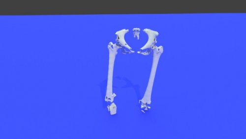 Femur Fracture - stl file processed - Extremity, Lower (Leg) - embodi3D.com