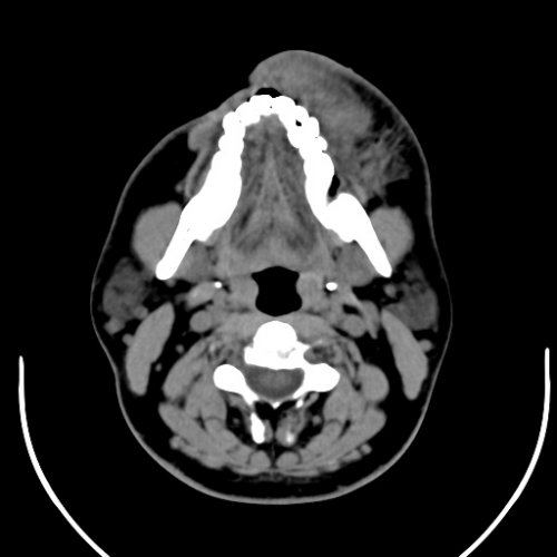 Dicom - Skull, Head, and Neck CTs - embodi3D.com