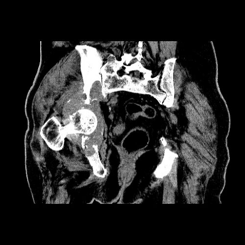 Test CTA file 2 - Abdomen and Pelvis CTs - embodi3D.com