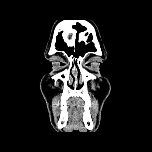 CT Scan - Coronal - Skull, Head, and Neck CTs - embodi3D.com