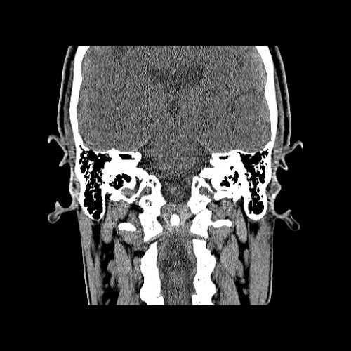 CT Scan - Coronal - Skull, Head, and Neck CTs - embodi3D.com